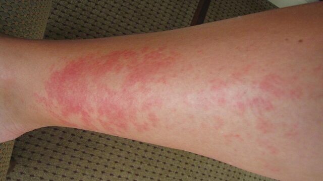 #hiker's rash Archives - eShopArchive - Essence of Lifesyle